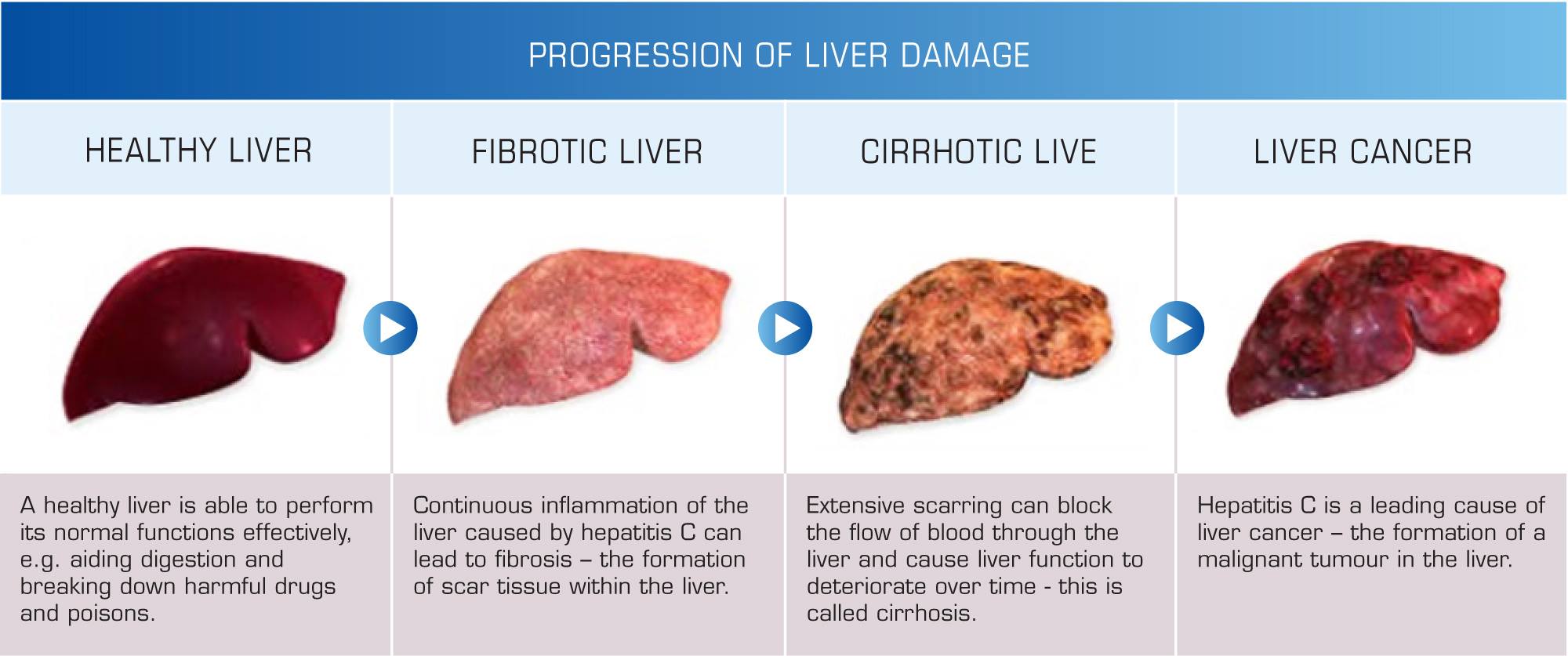 Liver Cirrhosis Curing In UCTC Liver Cirrhosis Curing In UCTC